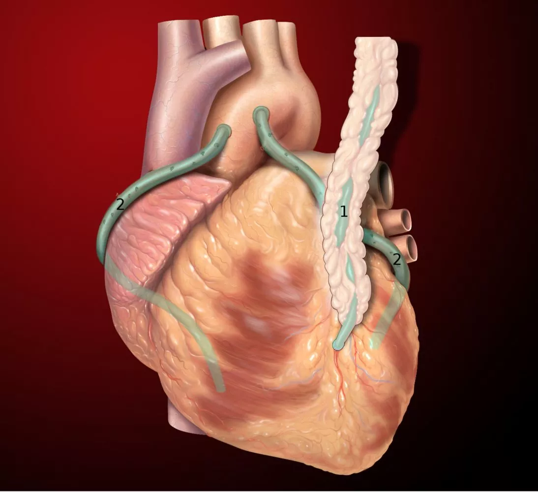 Off-Pump Beating Heart Coronary Artery Bypass Graft Surgery – iHEAL ...