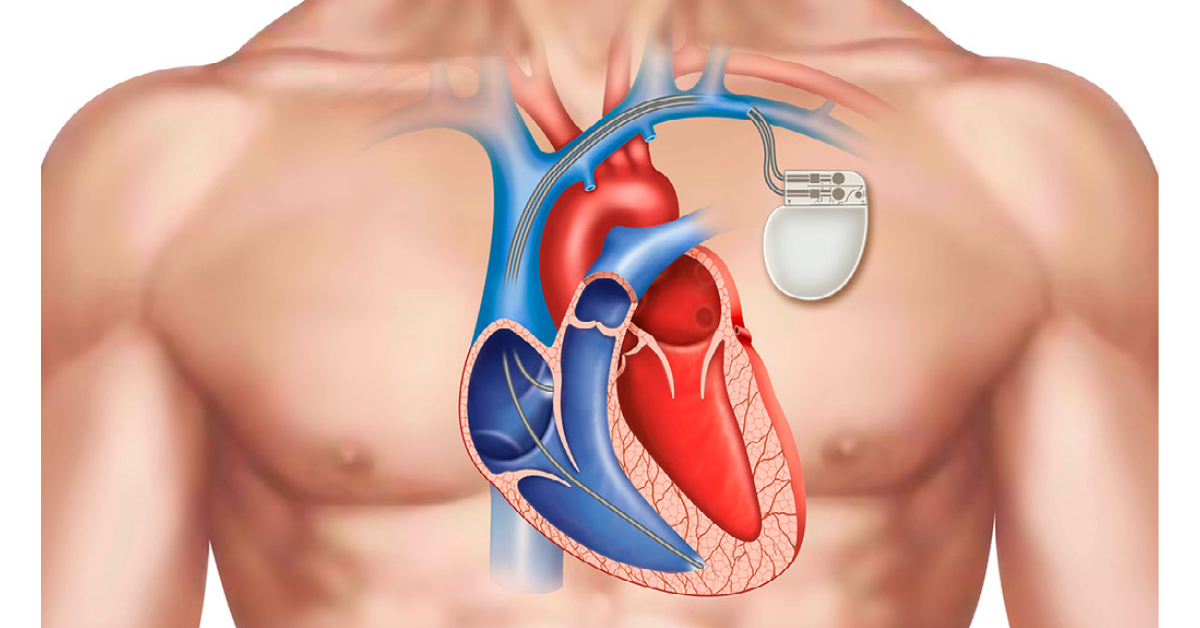 Pacemaker Implantation – iHEAL Medical Centre