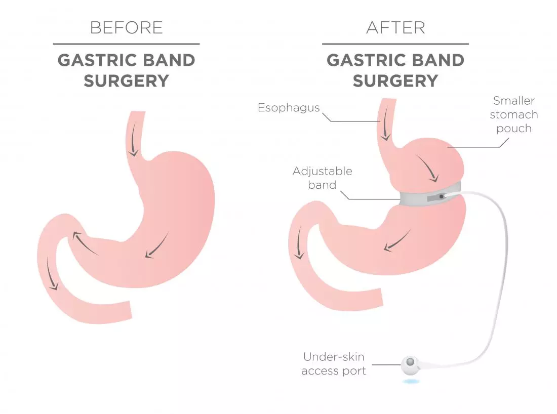 Laparoscopic adjustable gastric banding (LAGB) – iHEAL Medical Centre